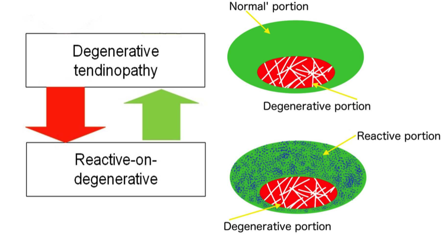 Mieux comprendre la prise en charge des tendinopathies en thérapie ...
